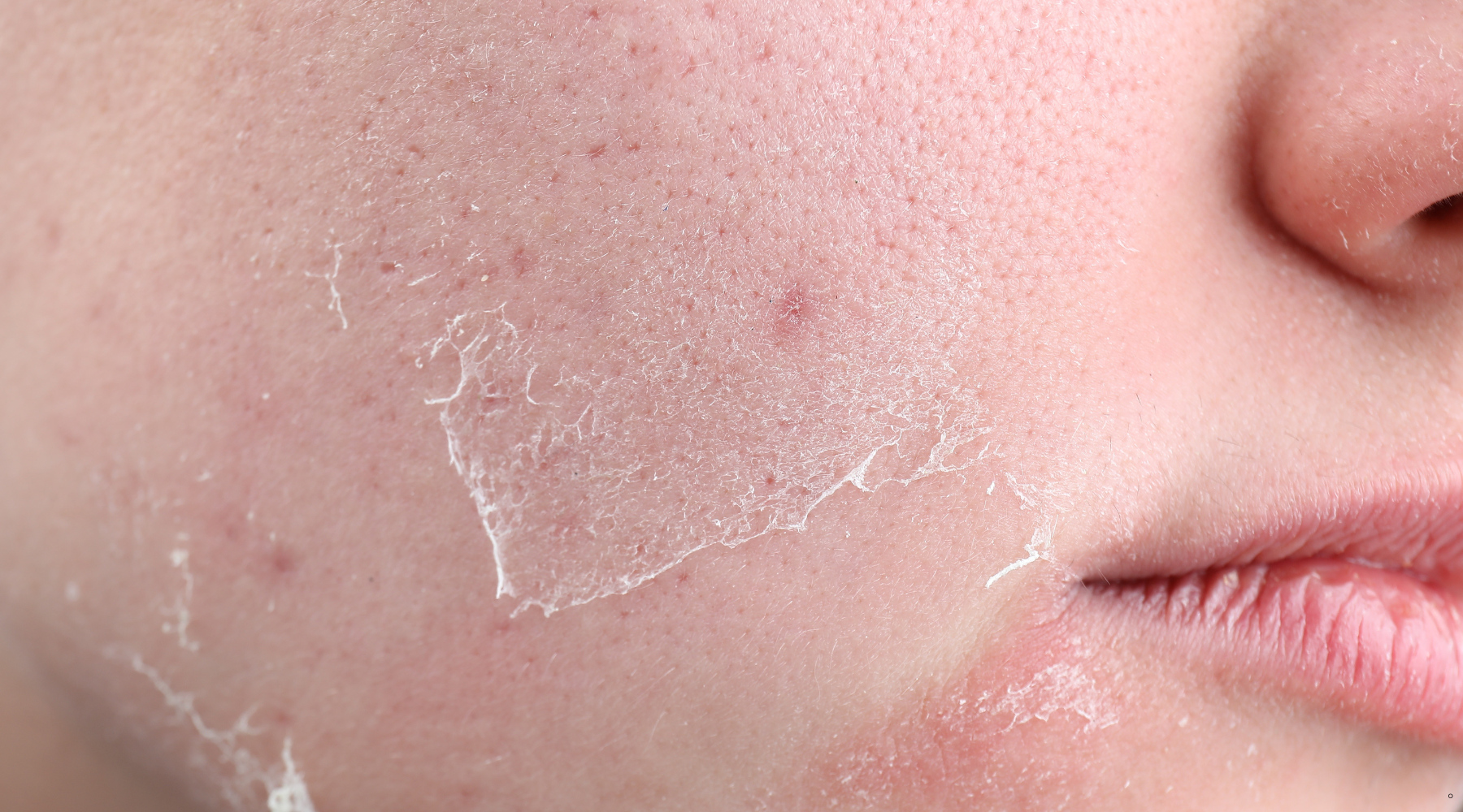 What Your Dermatologist Won't Tell You About Retinol